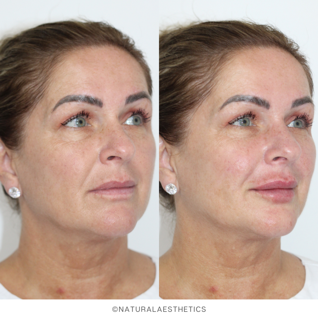 Lip Fillers with Restylane | Enhance Volume & Contour