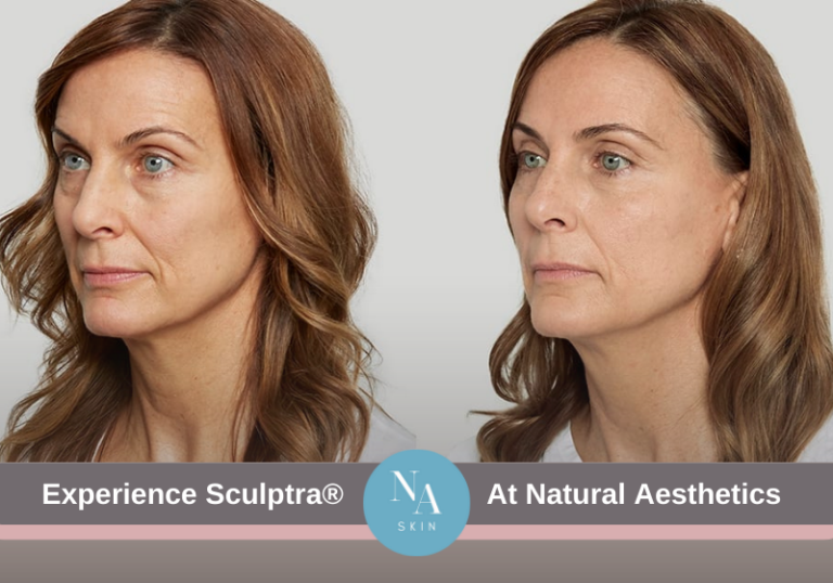 Sculptra®: PLLA Biostimulator Treatment - Natural Aesthetics