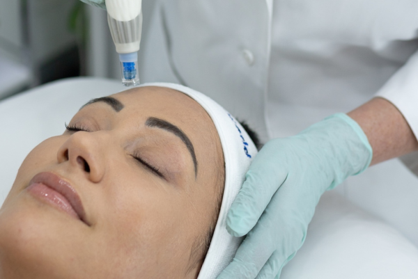 Microneedling with Dermapen 4 | Collagen Boost & Skin Rejuvenation