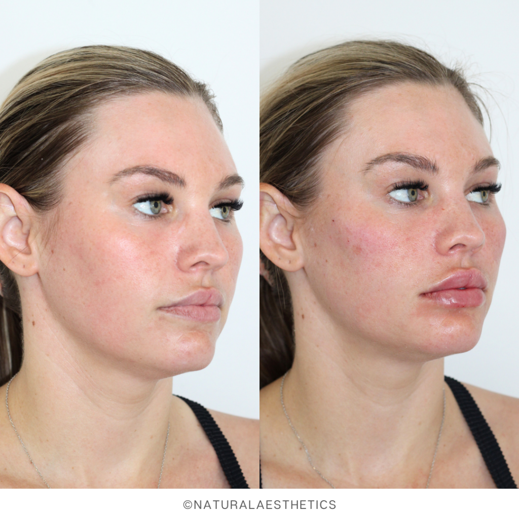 Dermal Filler Treatments | Natural Aesthetics Cape Town