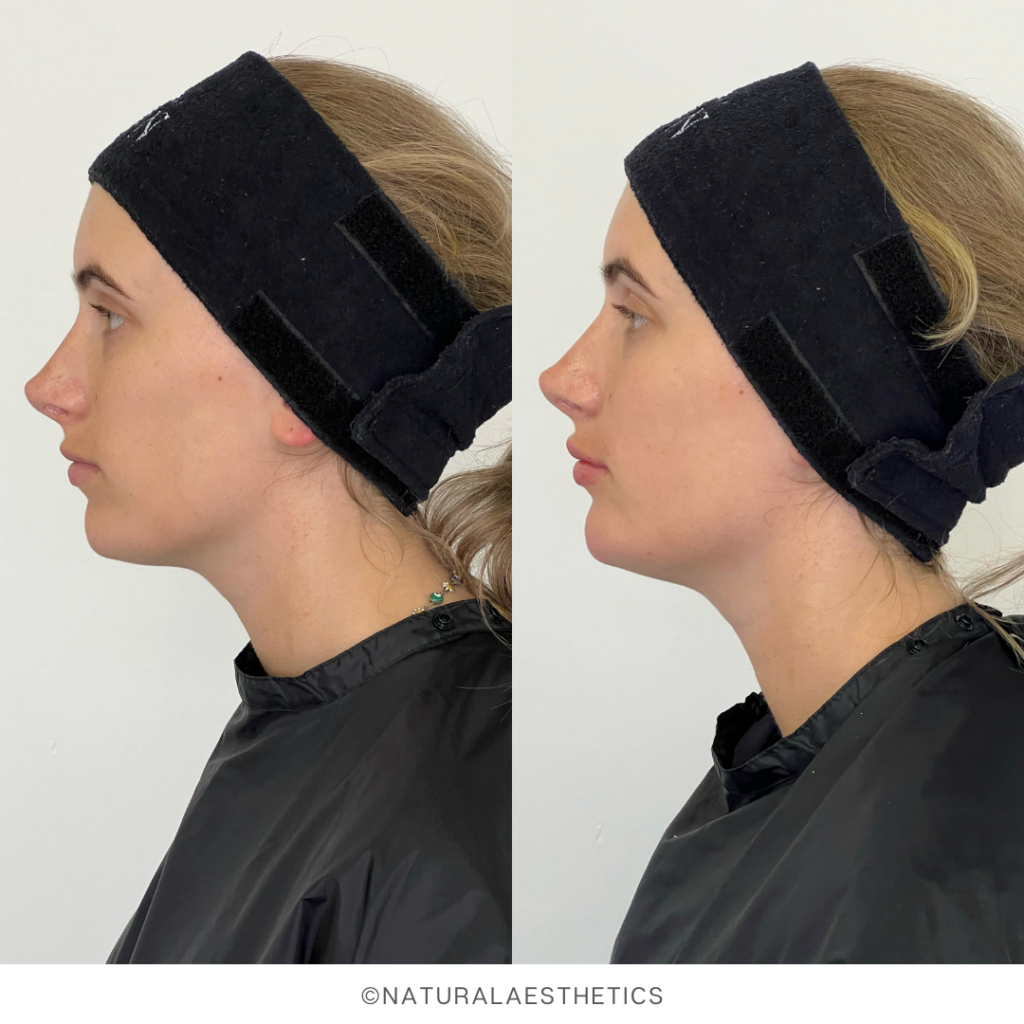 Dermal Filler Treatments | Natural Aesthetics Cape Town