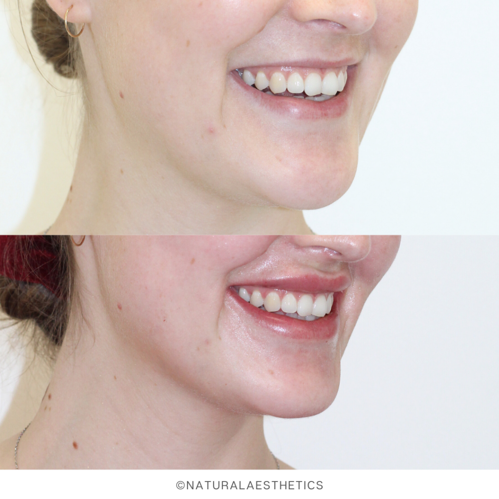 Lip Fillers with Restylane | Enhance Volume & Contour