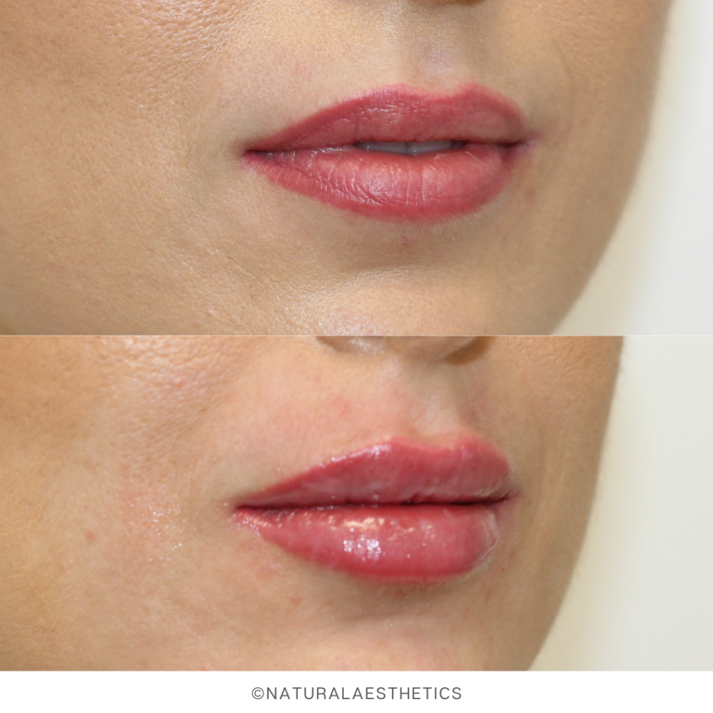 Dermal Filler Treatments | Natural Aesthetics Cape Town