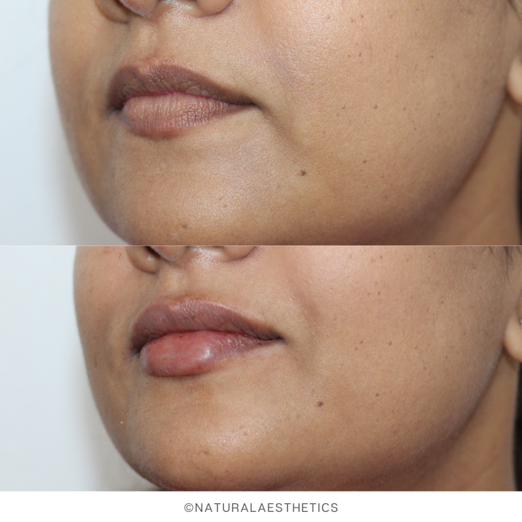 Lip Fillers with Restylane | Enhance Volume & Contour