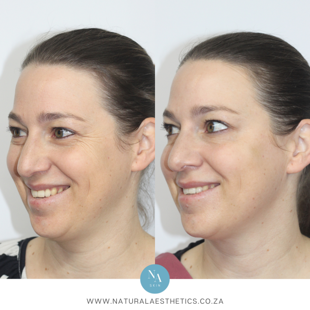 Restylane Skin Boosters | Deep Skin Hydration & Rejuvenation