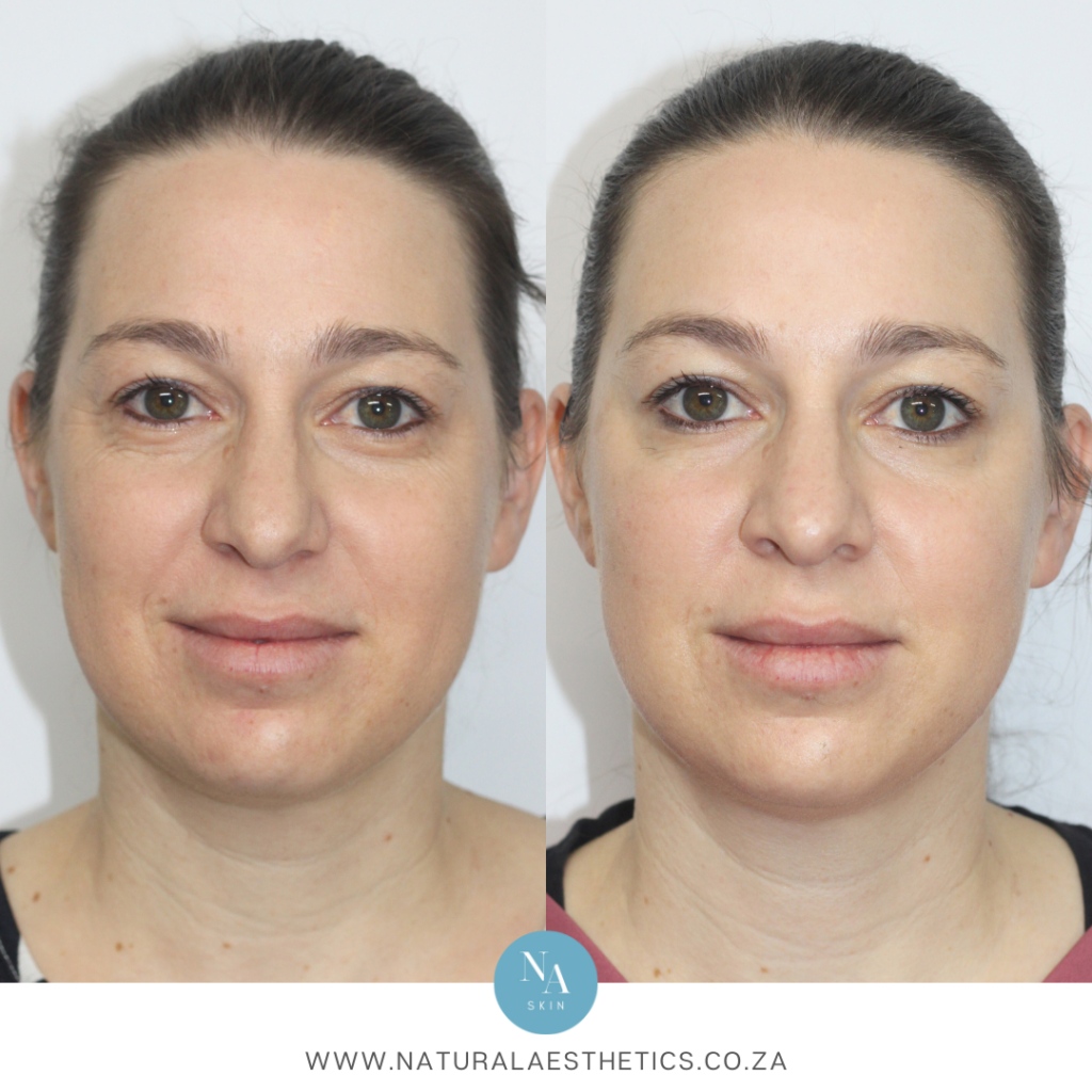 Dermal Filler Treatments | Natural Aesthetics Cape Town