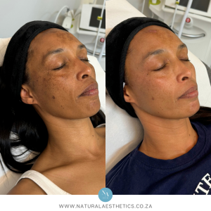 Hydroquinone Treatment For Pigmentation & Melasma