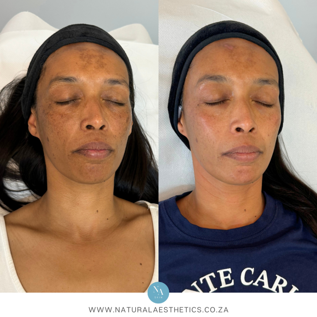 Hydroquinone Treatment For Pigmentation & Melasma