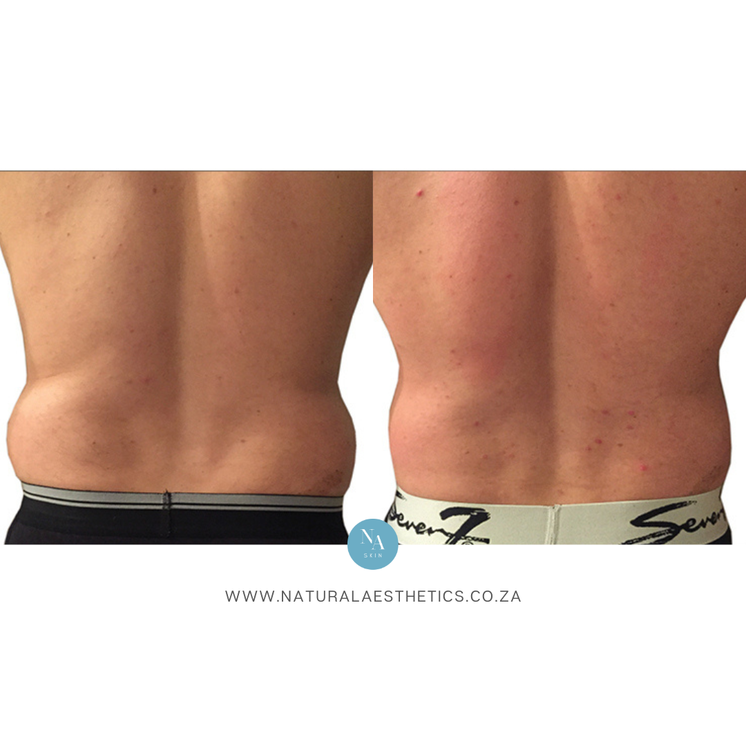 DiamondPolar RF Treatment | Skin Tightening & Wrinkle Reduction