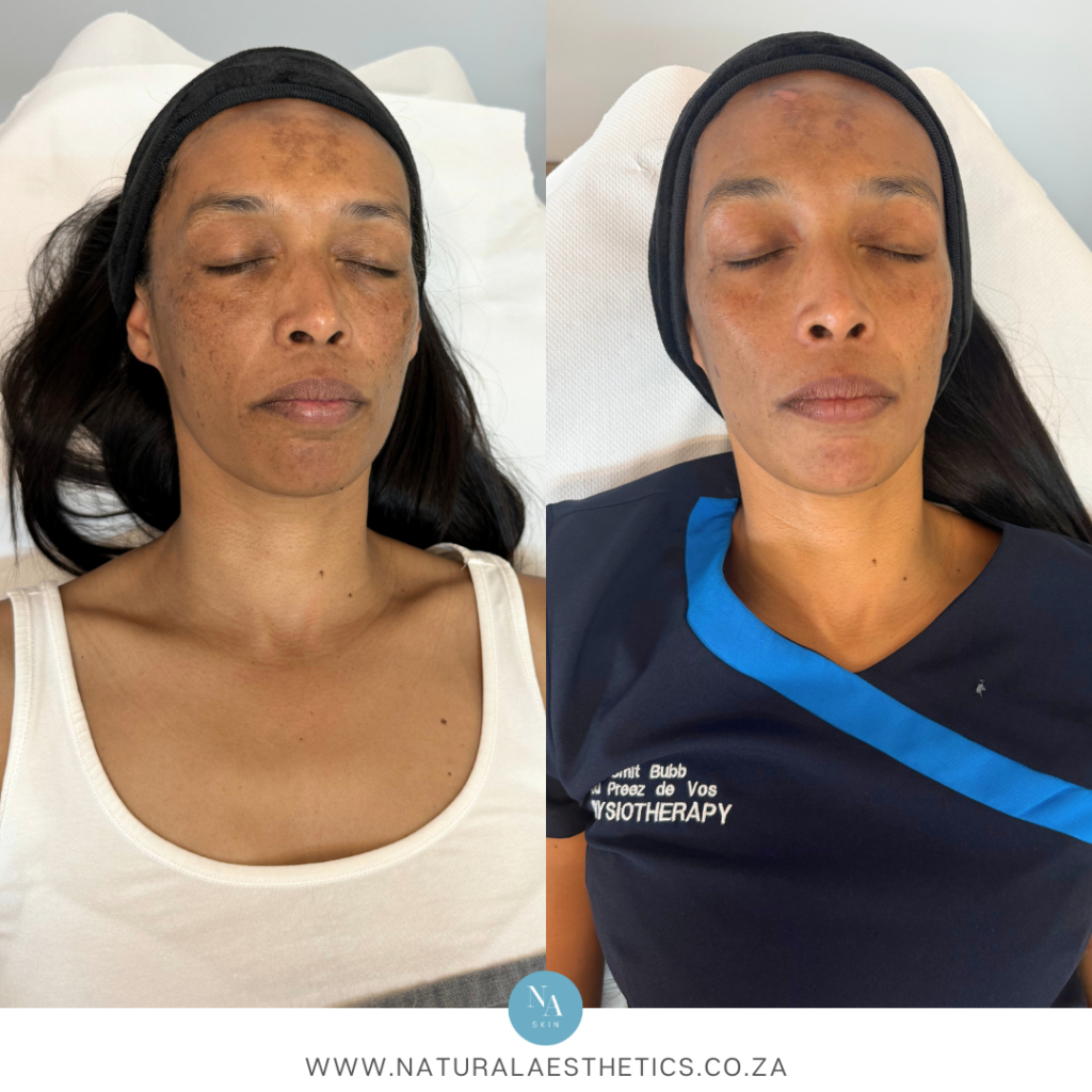 Hydroquinone Treatment Protocol | Target Pigmentation & Melasma
