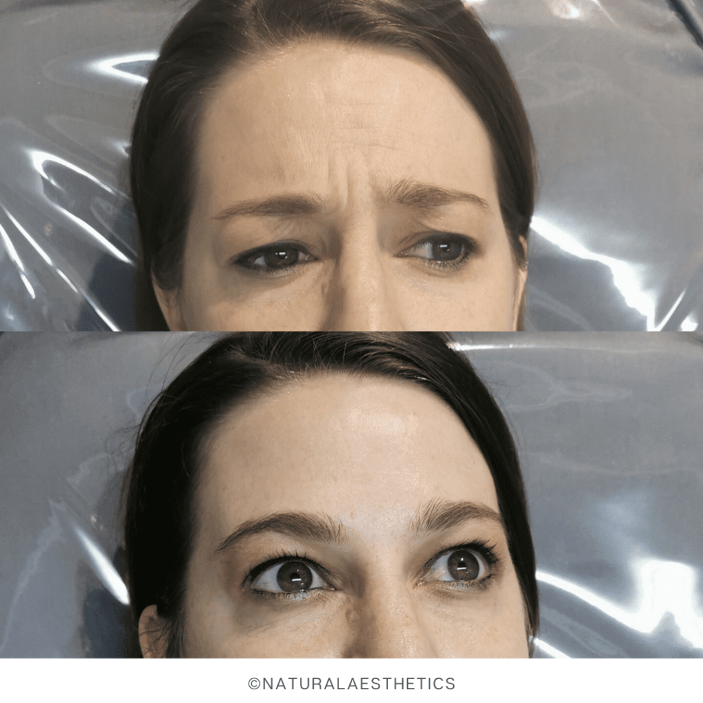Botox & Dysport | Achieve a Youthful Look with Anti-Wrinkle Injections
