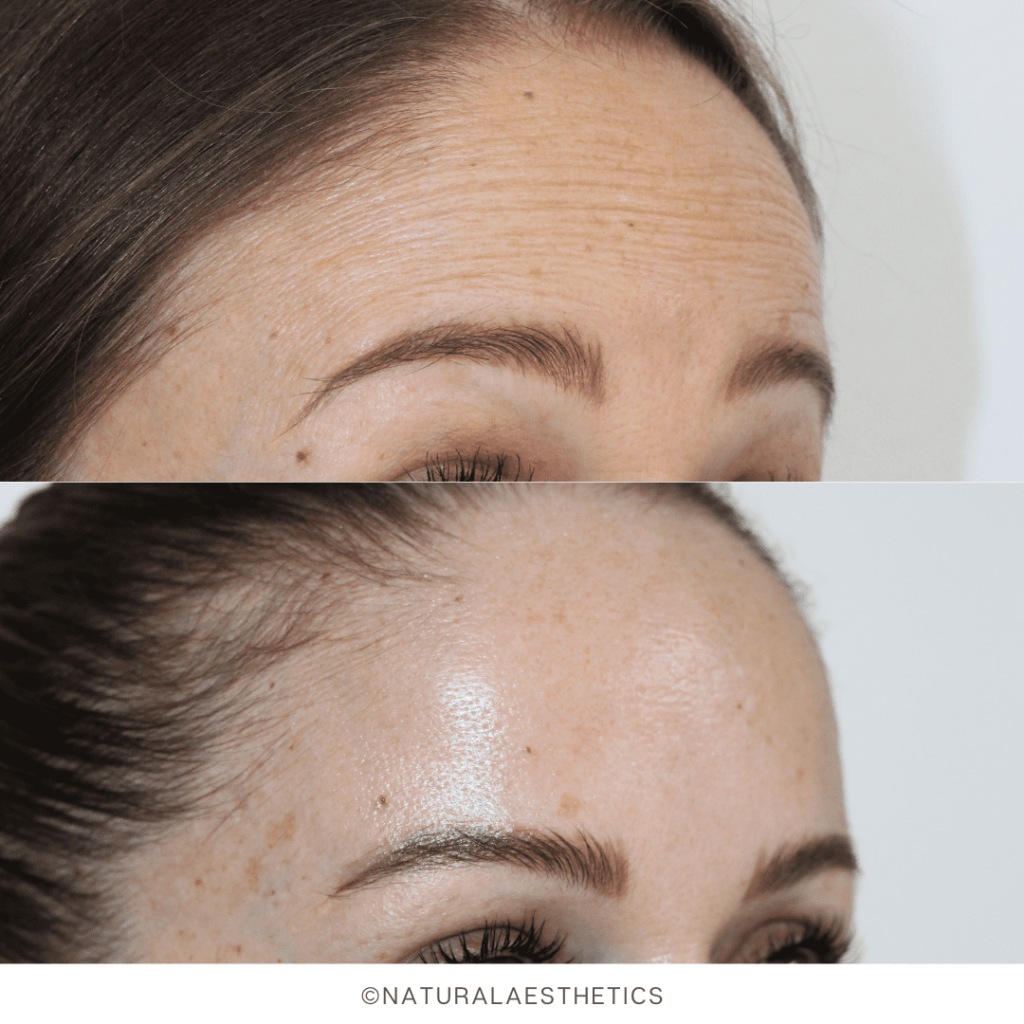 Botox & Dysport | Achieve a Youthful Look with Anti-Wrinkle Injections