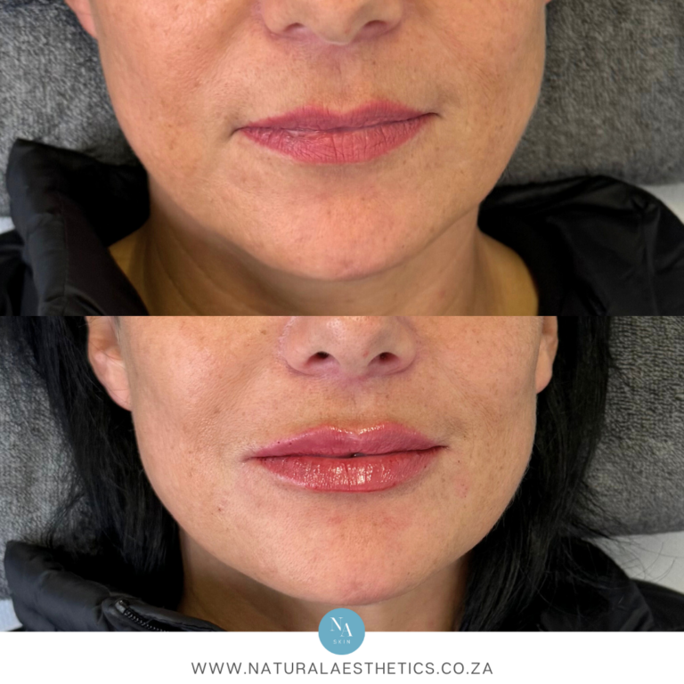 Dermal Filler Treatments | Natural Aesthetics Cape Town