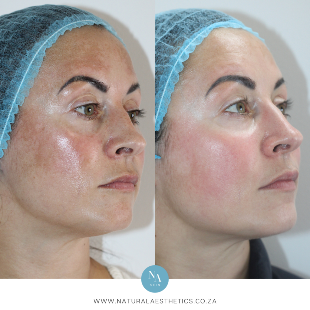 Cosmelan Peel | Effective Pigmentation Treatment