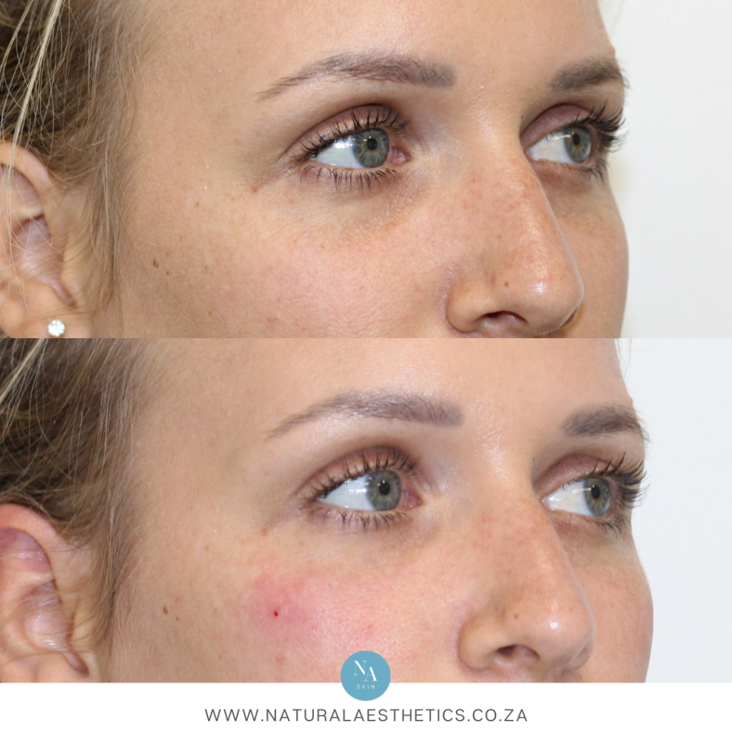 Dermal Filler Treatments | Natural Aesthetics Cape Town