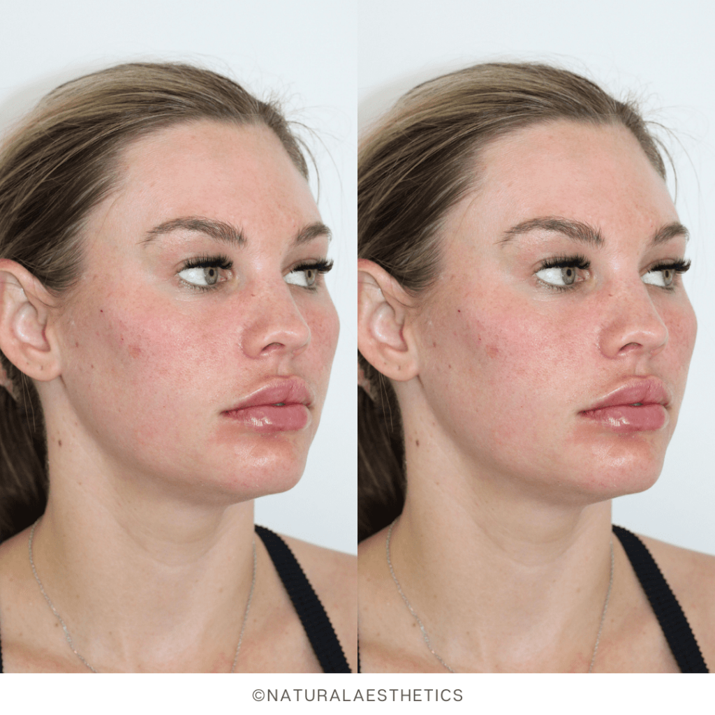 Restylane Fillers – Natural Aesthetics