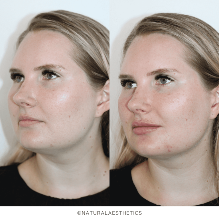 Dermal Filler Treatments | Natural Aesthetics Cape Town