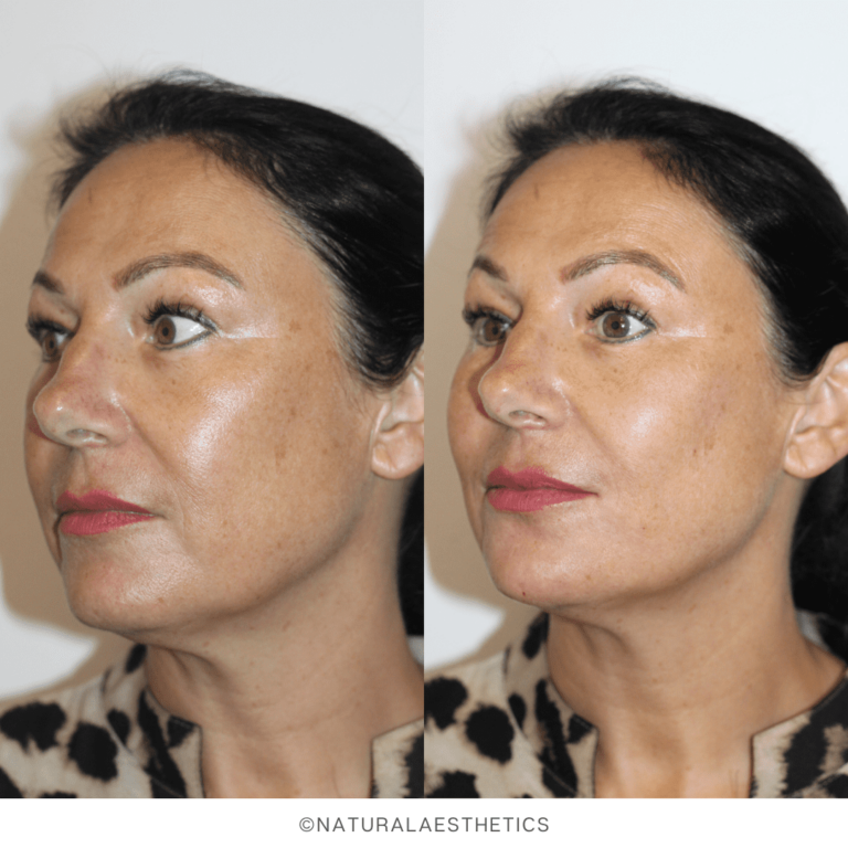 Dermal Filler Treatments | Natural Aesthetics Cape Town