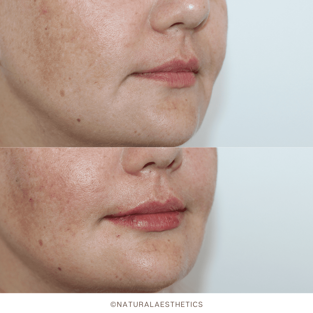 Restylane Fillers – Natural Aesthetics