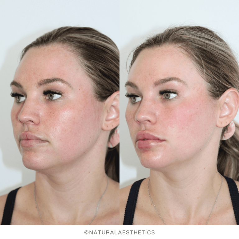 Dermal Filler Treatments | Natural Aesthetics Cape Town
