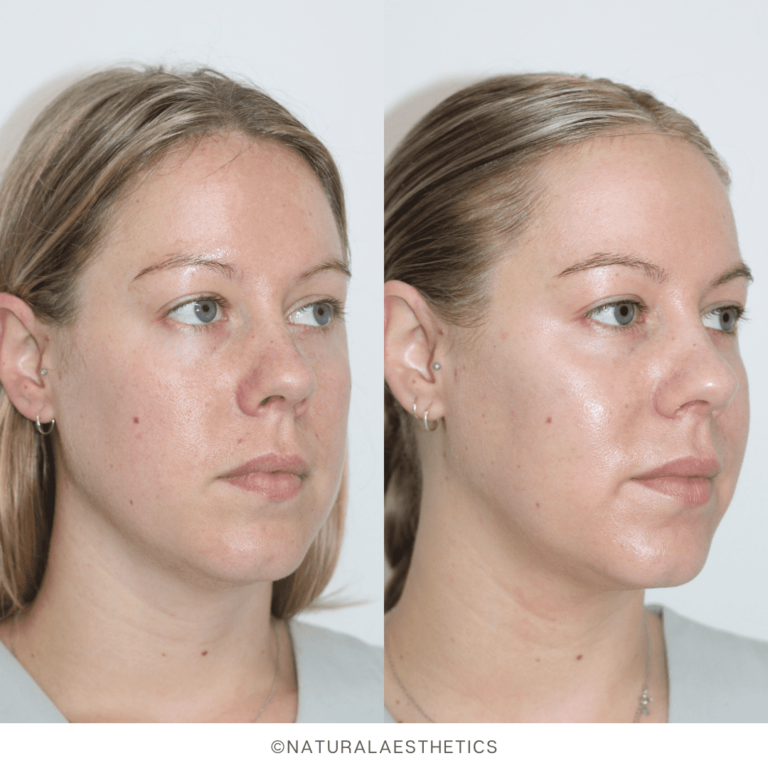 Dermal Filler Treatments | Natural Aesthetics Cape Town