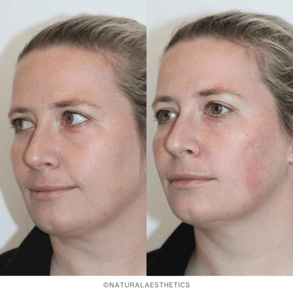 Dermal Filler Treatments | Natural Aesthetics Cape Town
