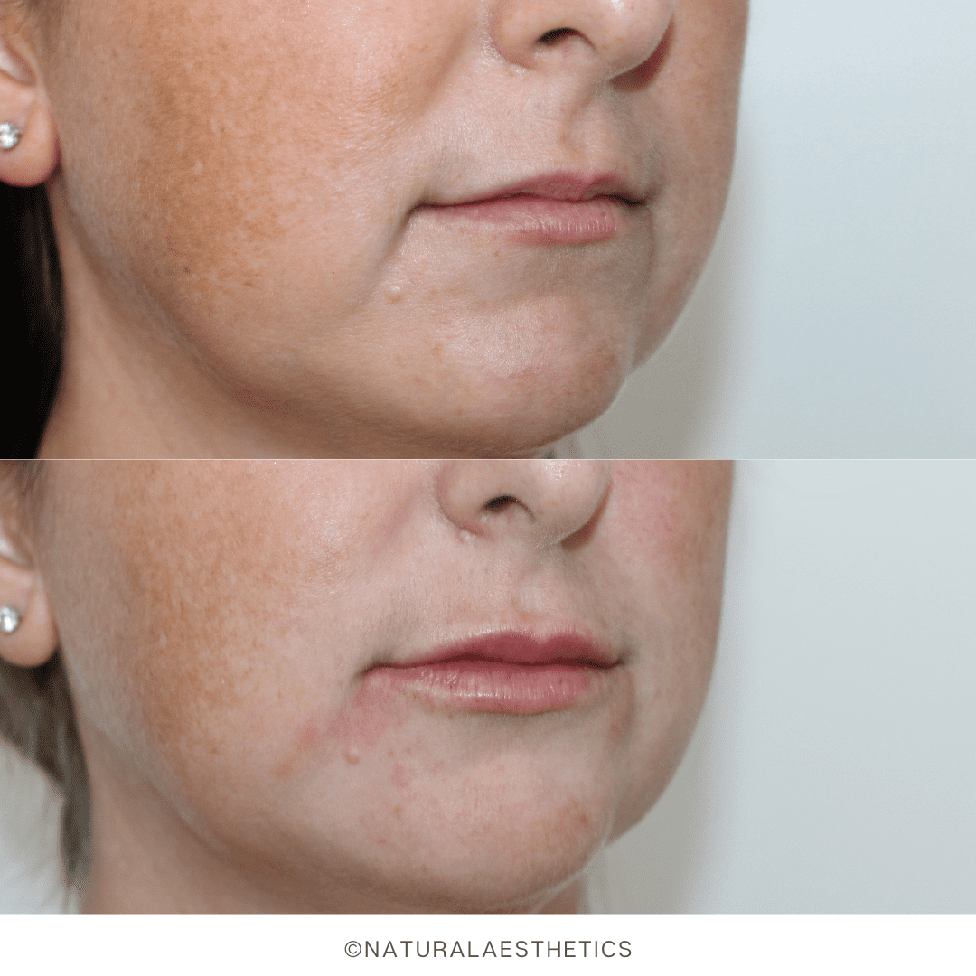 Restylane Fillers – Natural Aesthetics