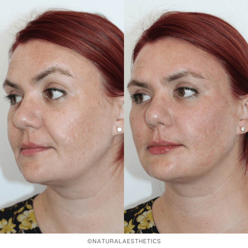 Dermal Filler Treatments | Natural Aesthetics Cape Town