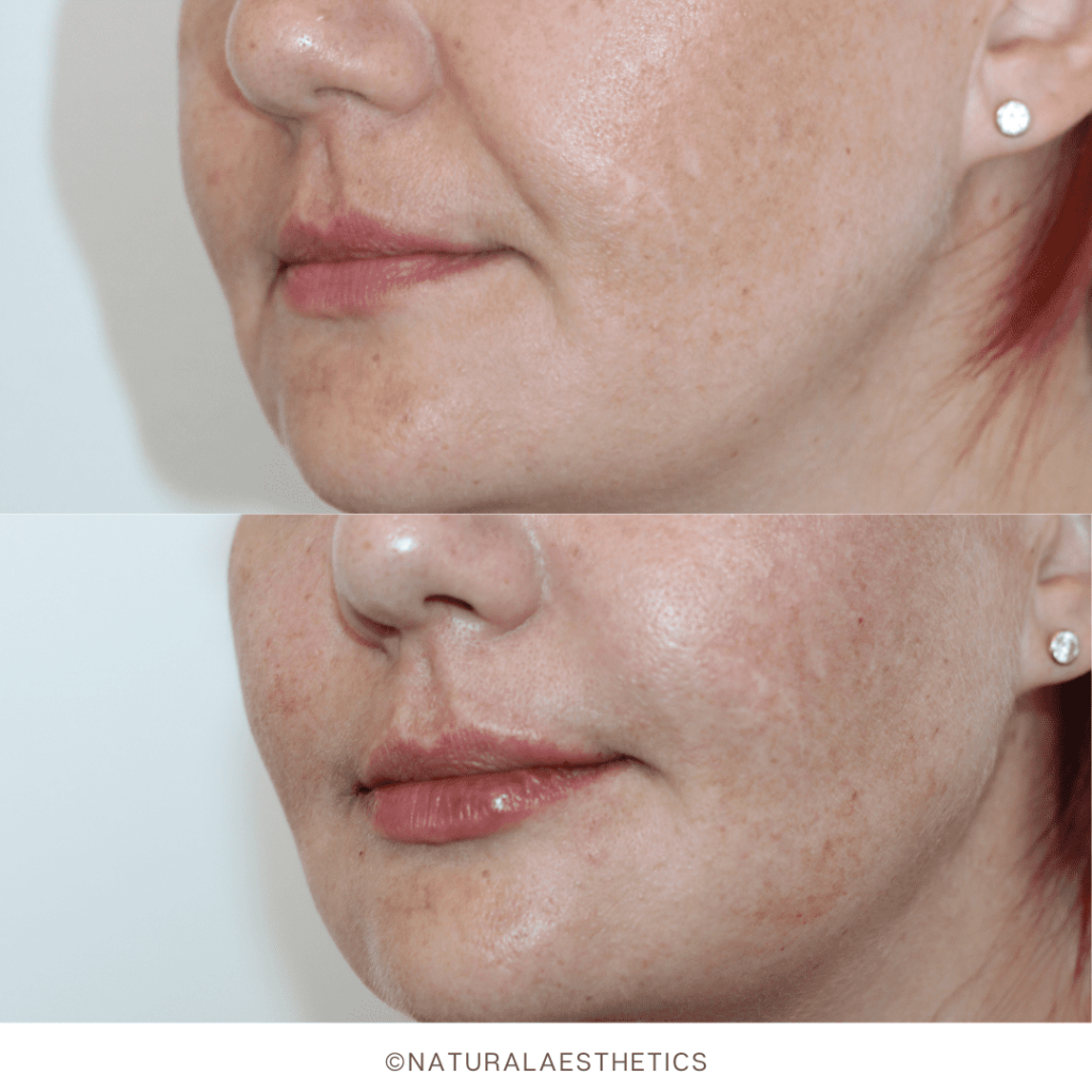 Dermal Filler Treatments | Natural Aesthetics Cape Town