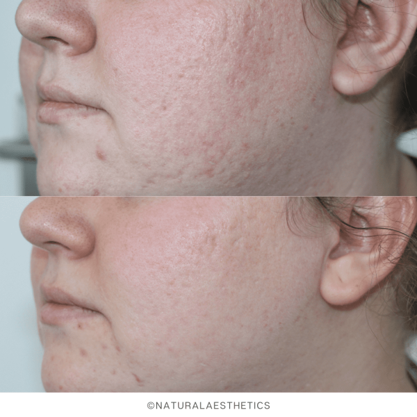 Microneedling with Dermapen 4 | Collagen Boost & Skin Rejuvenation