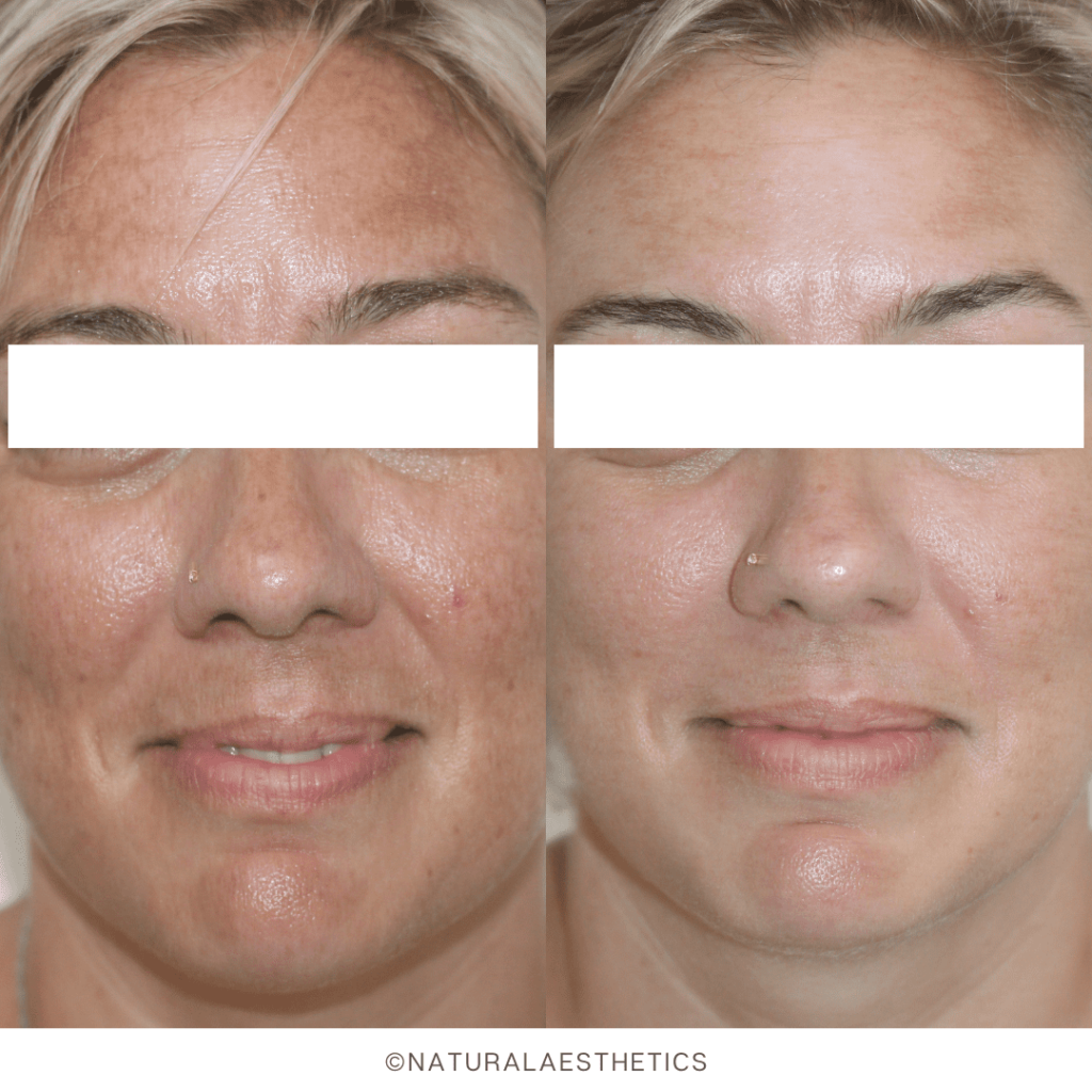 Microneedling with Dermapen 4 | Collagen Boost & Skin Rejuvenation