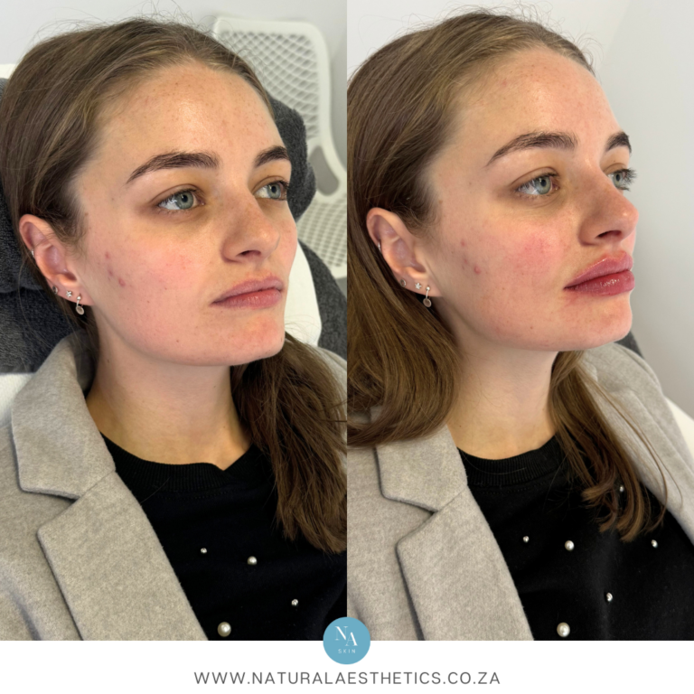 Dermal Filler Treatments | Natural Aesthetics Cape Town