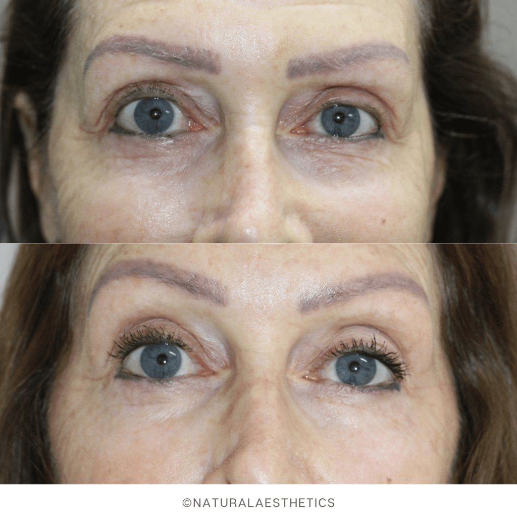 Plexr Plasma Treatment | Non-Surgical Skin Tightening