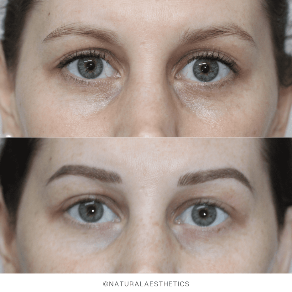 Plexr Plasma Treatment | Non-Surgical Skin Tightening
