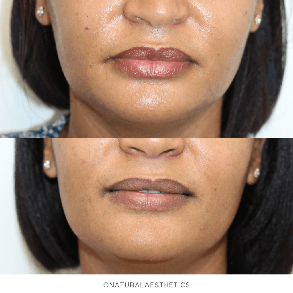 Plexr Plasma Treatment | Non-Surgical Skin Tightening