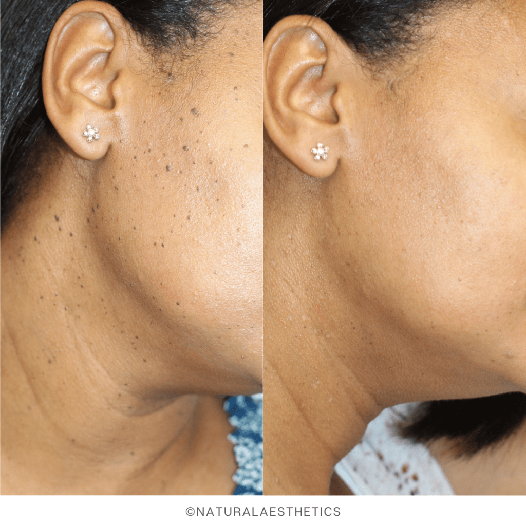 Plexr Plasma Treatment | Non-Surgical Skin Tightening