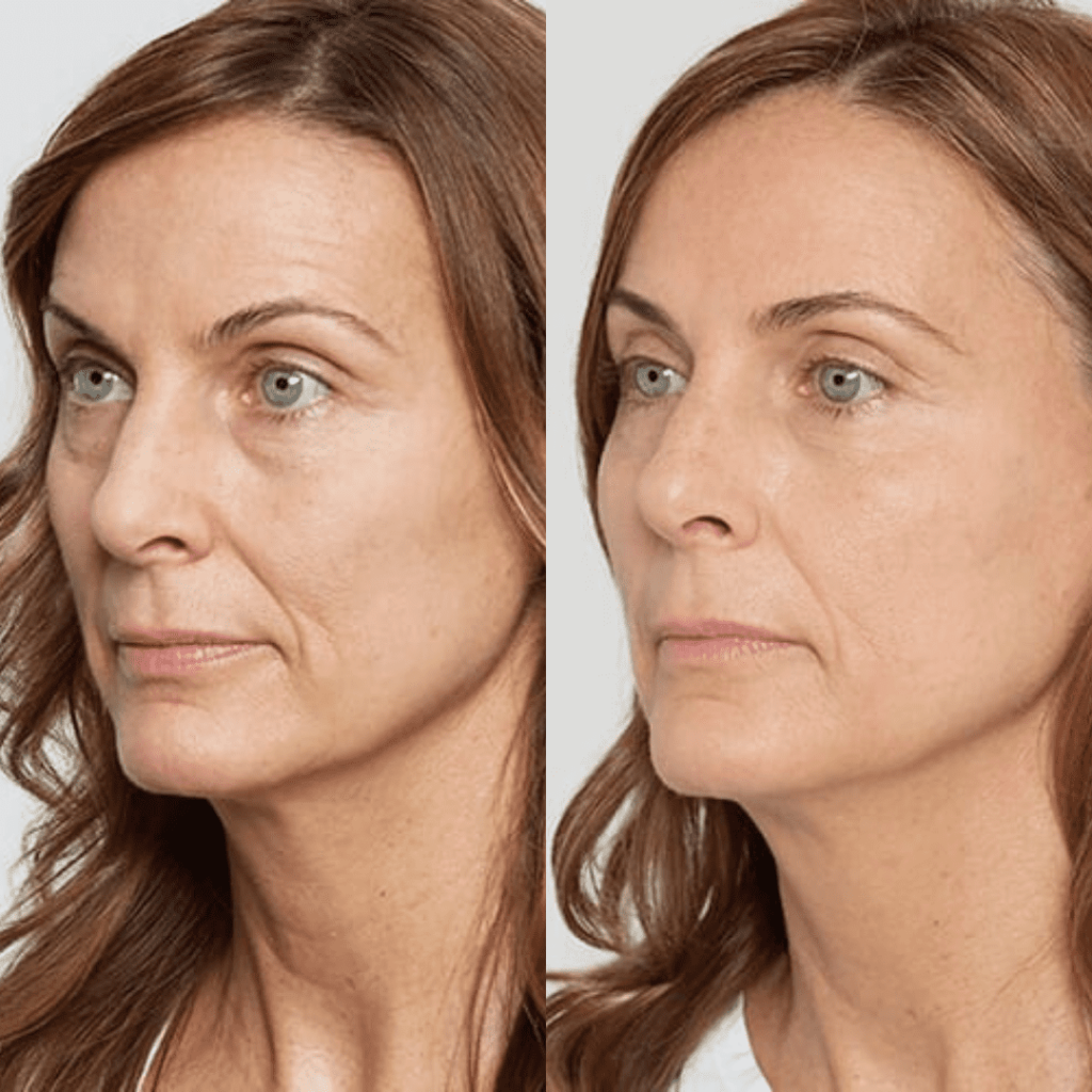 Sculptra Treatments | Collagen Biostimulator | Cape Town