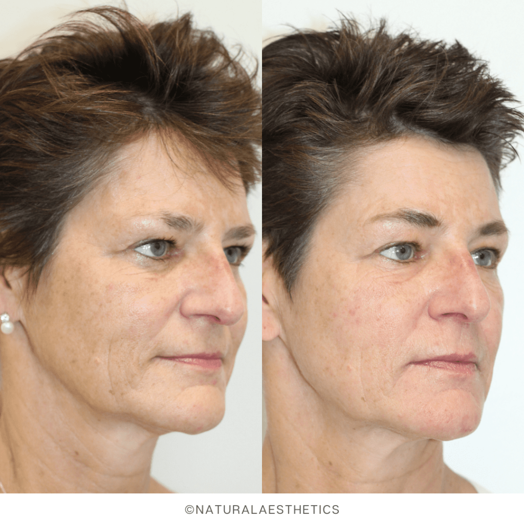 Sculptra Treatments | Collagen Biostimulator | Cape Town