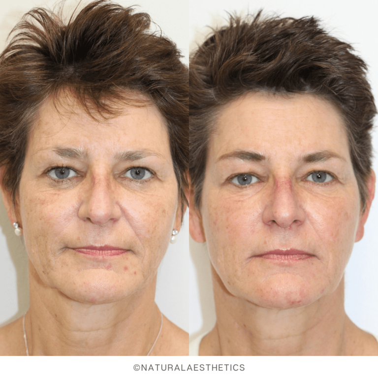 Sculptra Treatments | Collagen Biostimulator | Cape Town