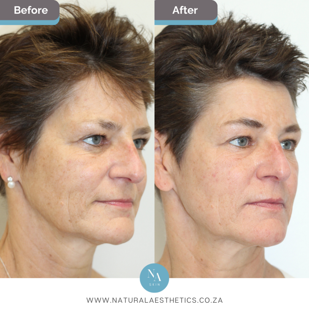 Sculptra®: PLLA Biostimulator Treatment - Natural Aesthetics