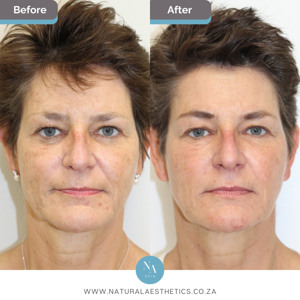 Sculptra®: PLLA Biostimulator Treatment - Natural Aesthetics