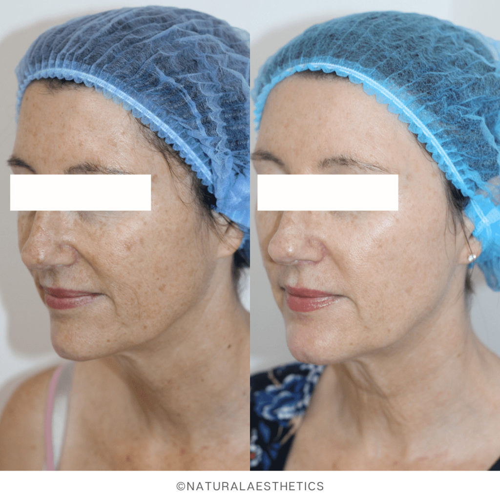 IPL Laser Skin Treatment | Target Pigmentation & Rosacea