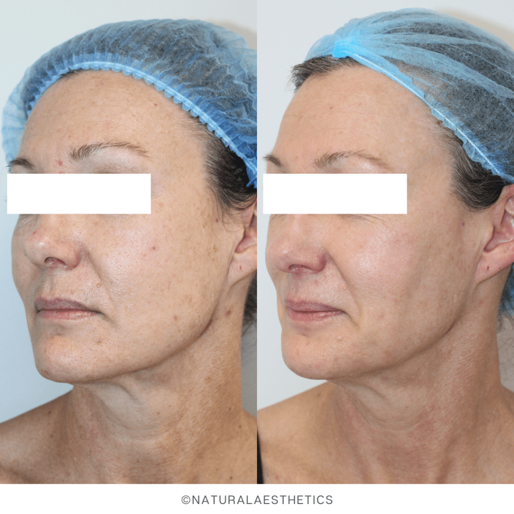 IPL Laser Skin Treatment | Target Pigmentation & Rosacea